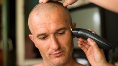 Bald Before And After - Ultimate Balding Transformation Of Some Members