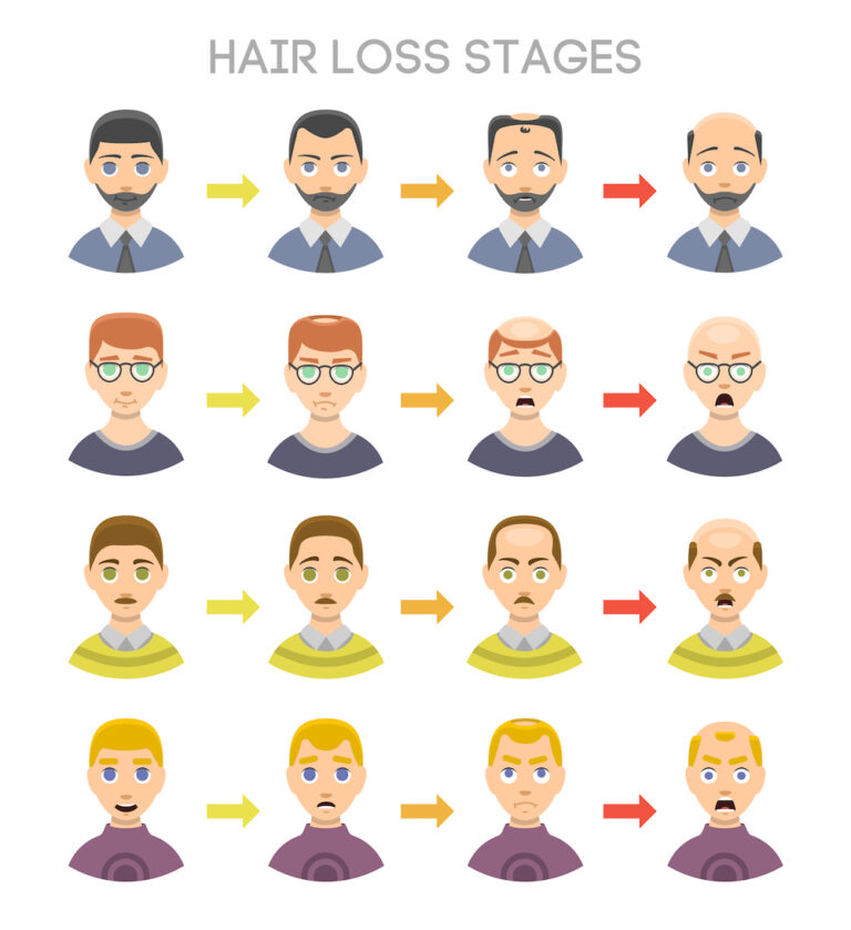 How To Deal With A Receding Hairline Like A Boss