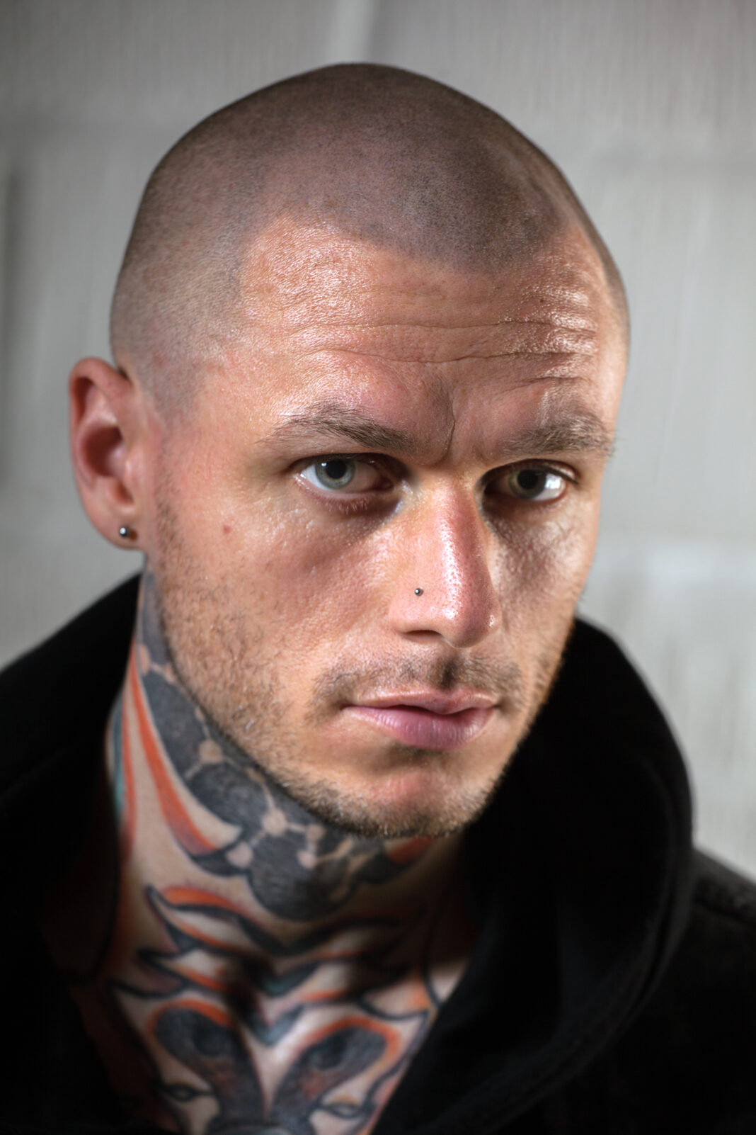 Scalp Micropigmentation With Eve From Velvet Micropigmentation