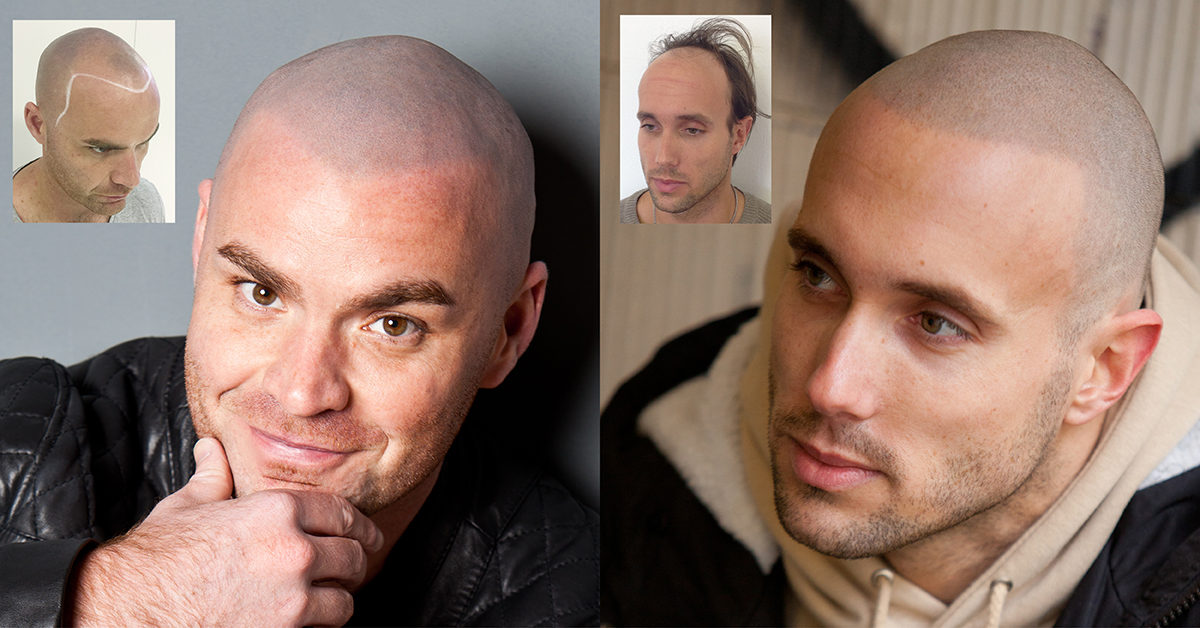 Skalp Clinic - Everything You Need to Know About Scalp Micropigmentation