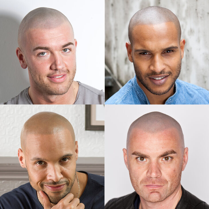 Skalp Clinic - Everything You Need to Know About Scalp Micropigmentation