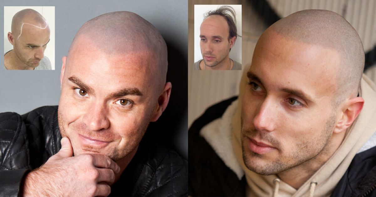 Skalp Clinic - Everything You Need to Know About Scalp Micropigmentation
